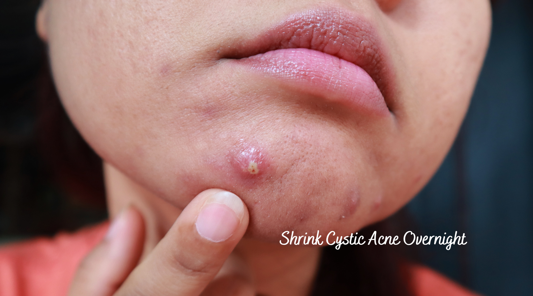 How to Shrink a Cystic Pimple Overnight - TRULY CLEAR – Truly Clear