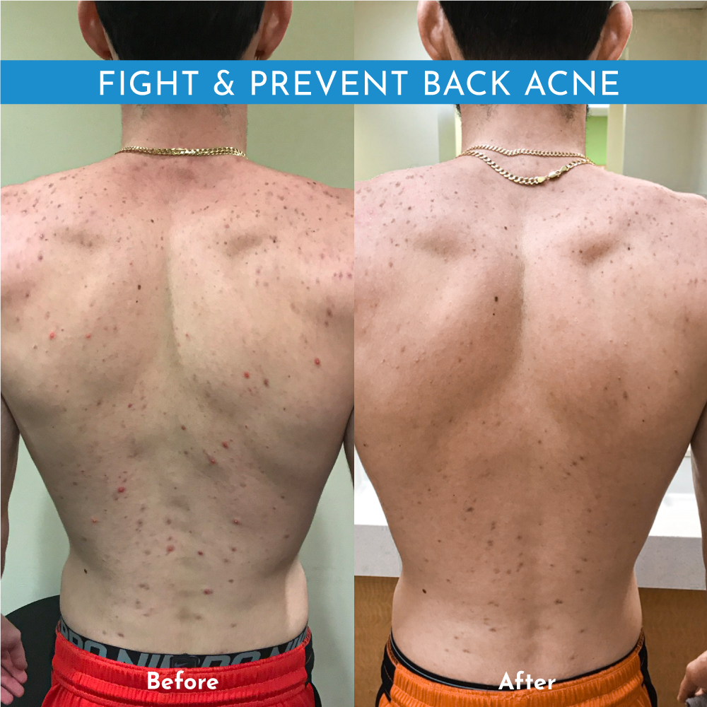 Truly Clear Acne Bar - 1-Step Cleanser for Breakout-Prone Skin