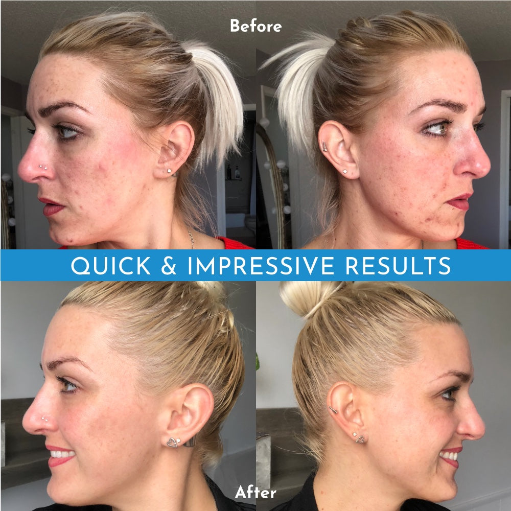 Truly Clear Acne Bar - 1-Step Cleanser for Breakout-Prone Skin